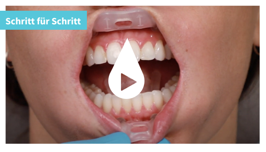 Umbrella™ Zungen-, Lippen- und Wangenhalter